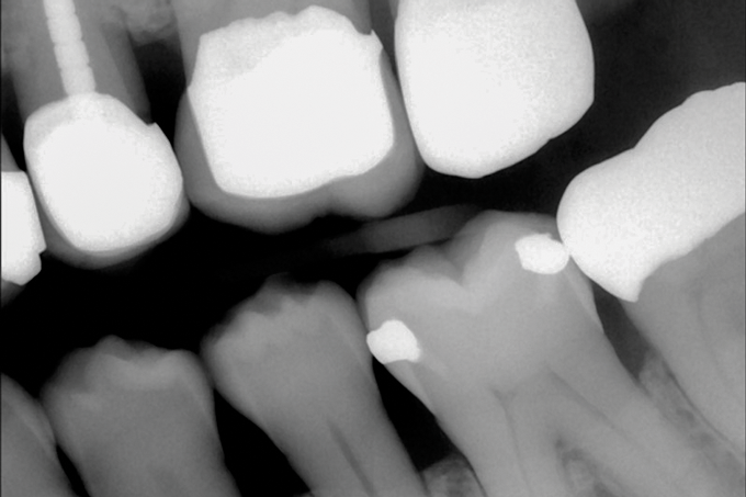 Mastering Crown & Bridge Impressions - Burkhart Dental Supply