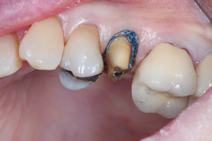 Mastering Crown & Bridge Impressions - Burkhart Dental Supply