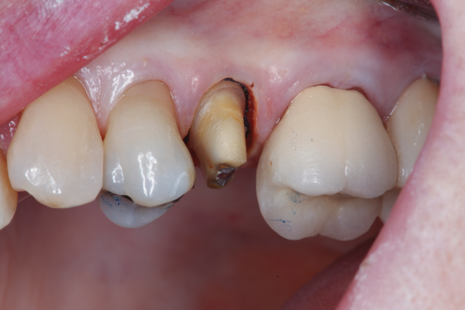 Mastering Crown & Bridge Impressions - Burkhart Dental Supply