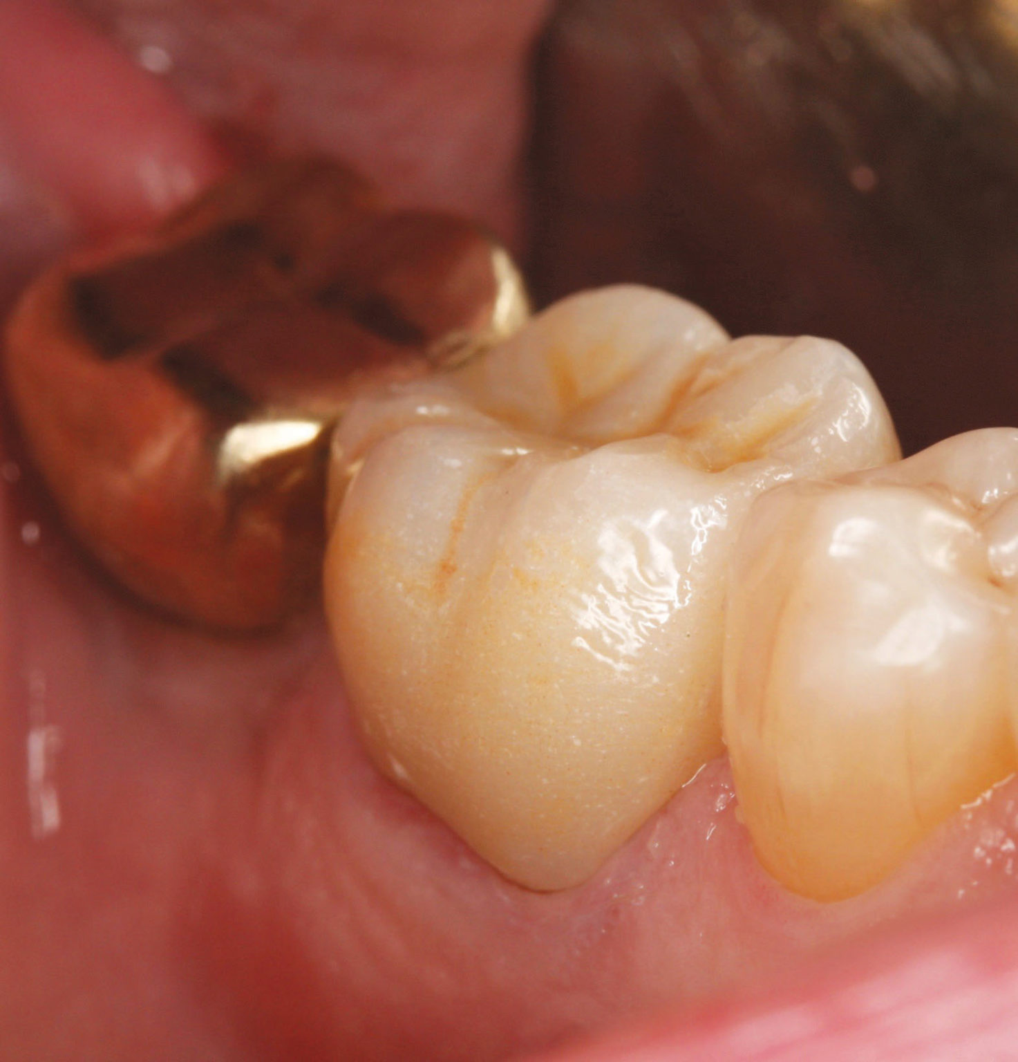 Self-Adhesive Resin - ZR-Cem™ - Burkhart Dental Supply