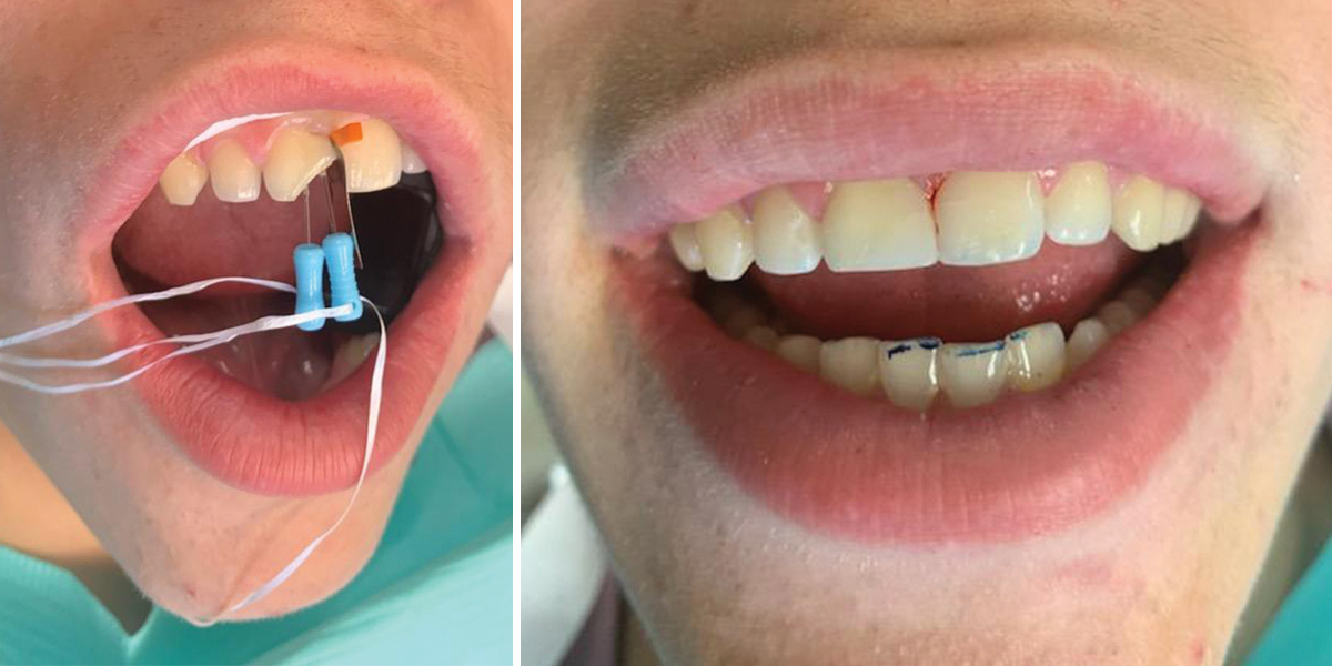 New Dental Glass Pin Transforms Tooth Repair - Burkhart Dental Supply